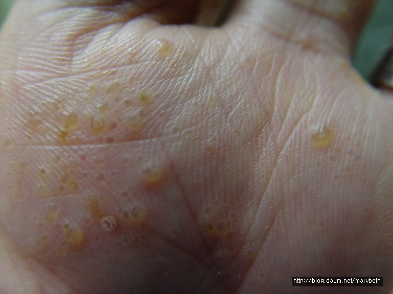 수포성 무좀 | 괴담/오컬트